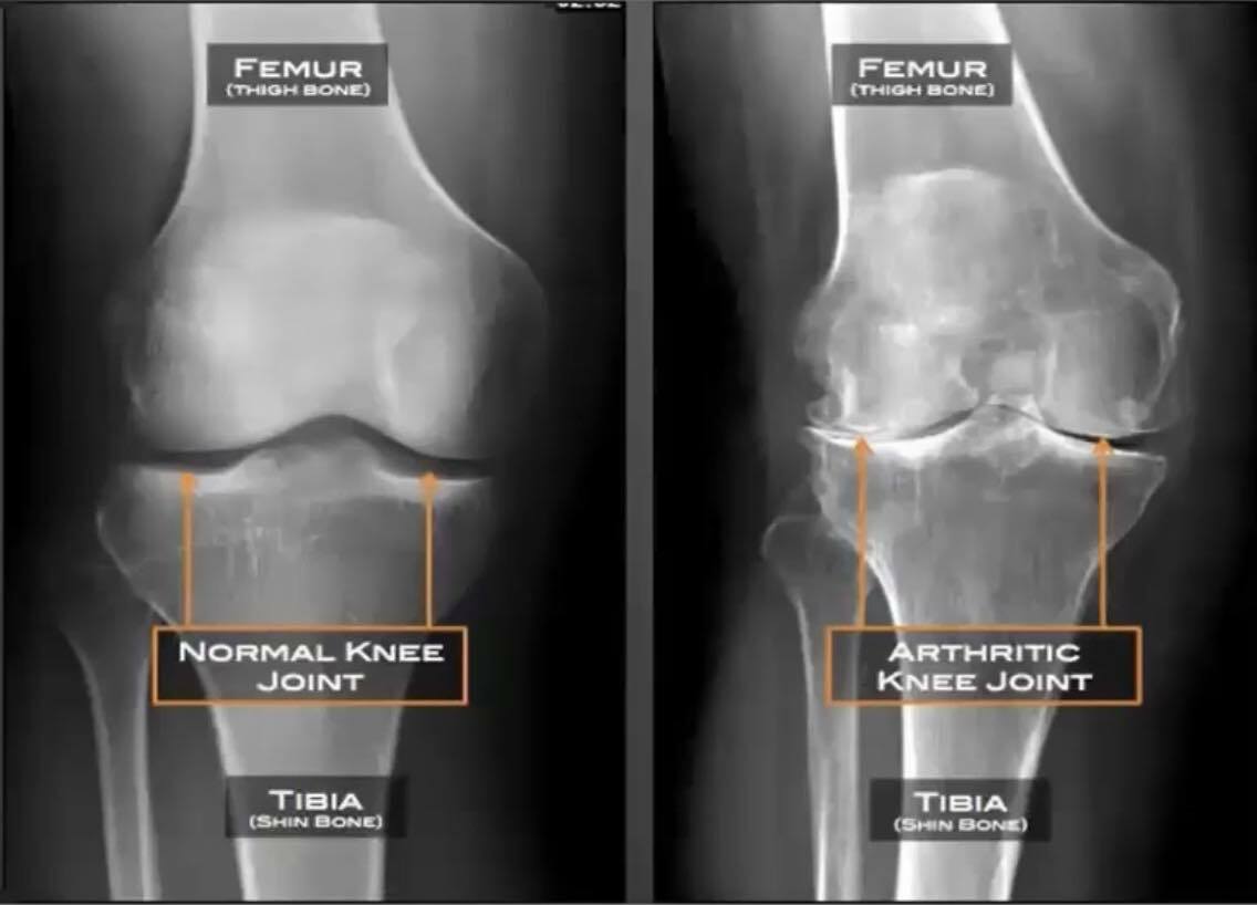 Focused Shockwave Therapy | Capalaba Chiropractor